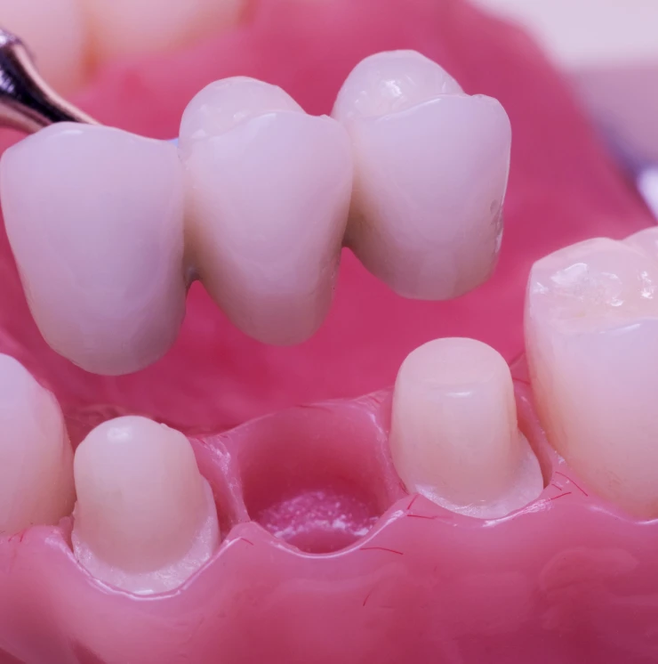 Dental Crowns | Porcelain Crowns In Tampa, FL | Dental Crowns 33635, FL | Tampa Dental Studio