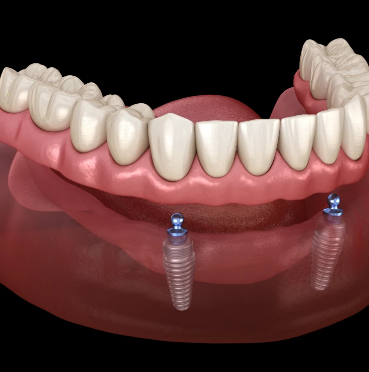 Denture Stabilization in Tampa, FL | Denture Stabilization 33635, FL ...