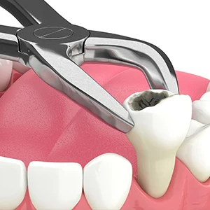 The Cost of Tooth Extractions Affordable Dental Care in Tampa